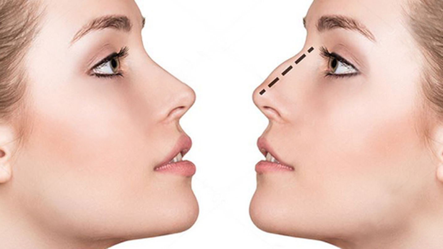 Eye, Temple, and Nose Aesthetic Treatments Miami & Hollywood, FL