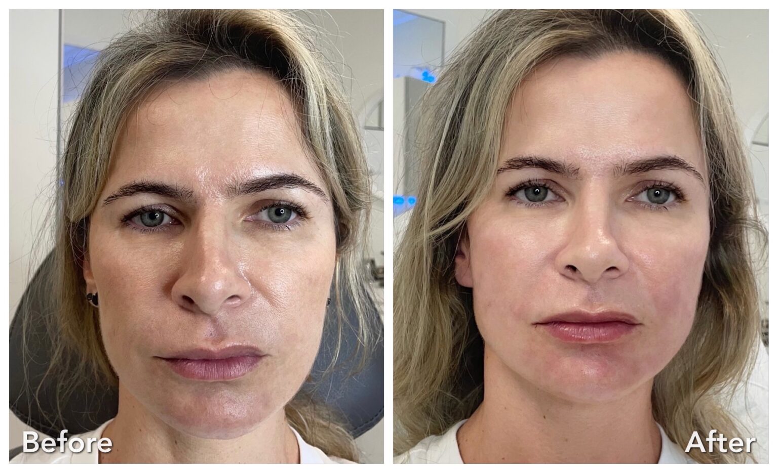 PDO Thread Lift Miami | PDO Thread Skin Lift Near ME